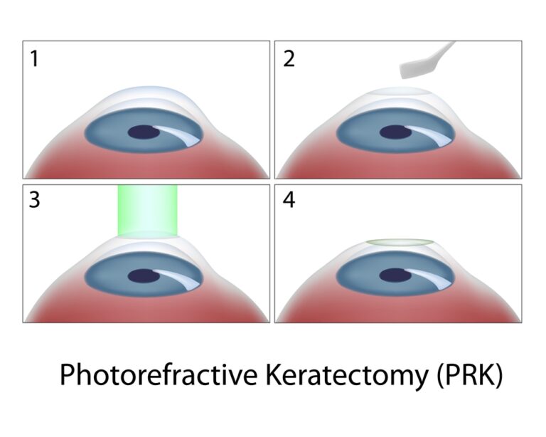 PRK Calgary AB | Laser Eye Surgery Calgary | Clarity Laser Vision
